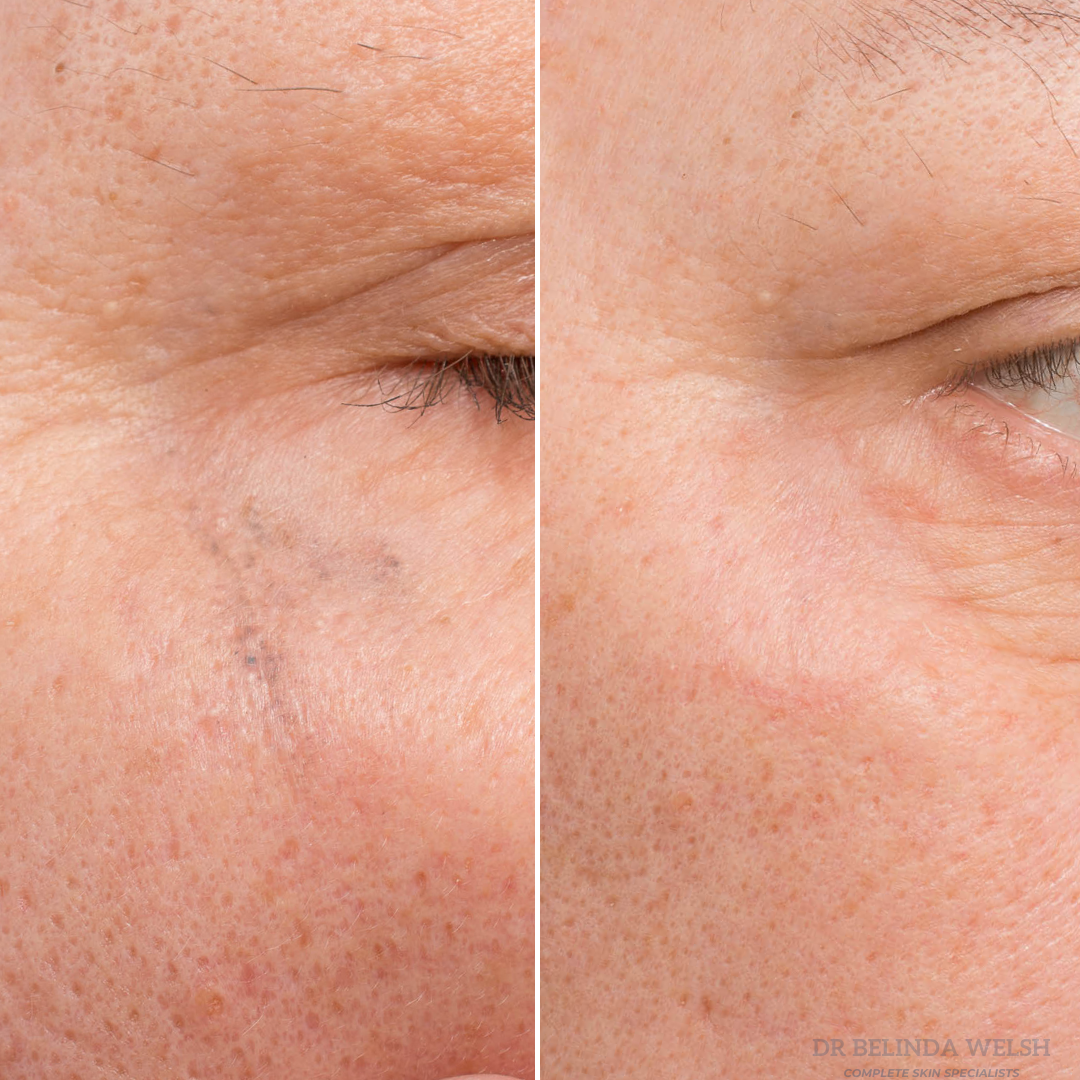 How to Remove Traumatic Tattoos: Causes, Types & Laser Treatments – Dr ...